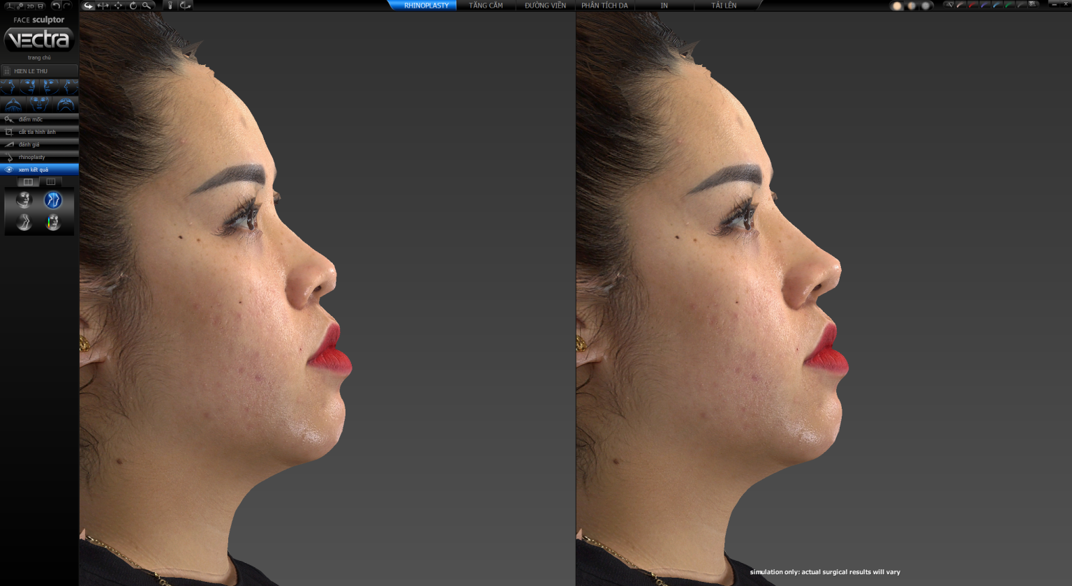 CÔNG NGHỆ MÔ PHỎNG VECTRA XT 3D XEM TRƯỚC DIỆN MẠO TƯƠNG LAI - Thẩm Mỹ ...