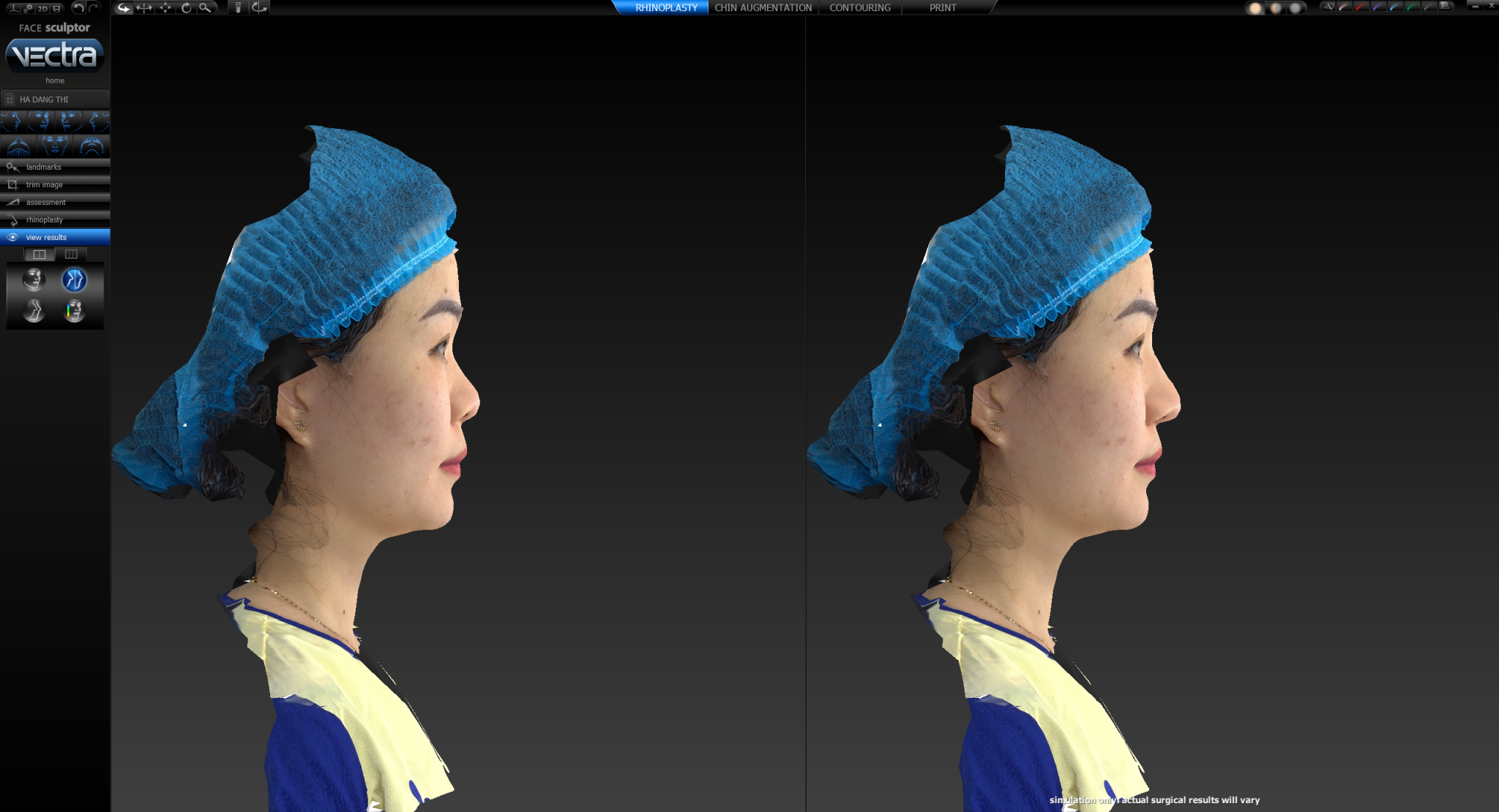 CÔNG NGHỆ MÔ PHỎNG VECTRA XT 3D XEM TRƯỚC DIỆN MẠO TƯƠNG LAI - Thẩm Mỹ ...