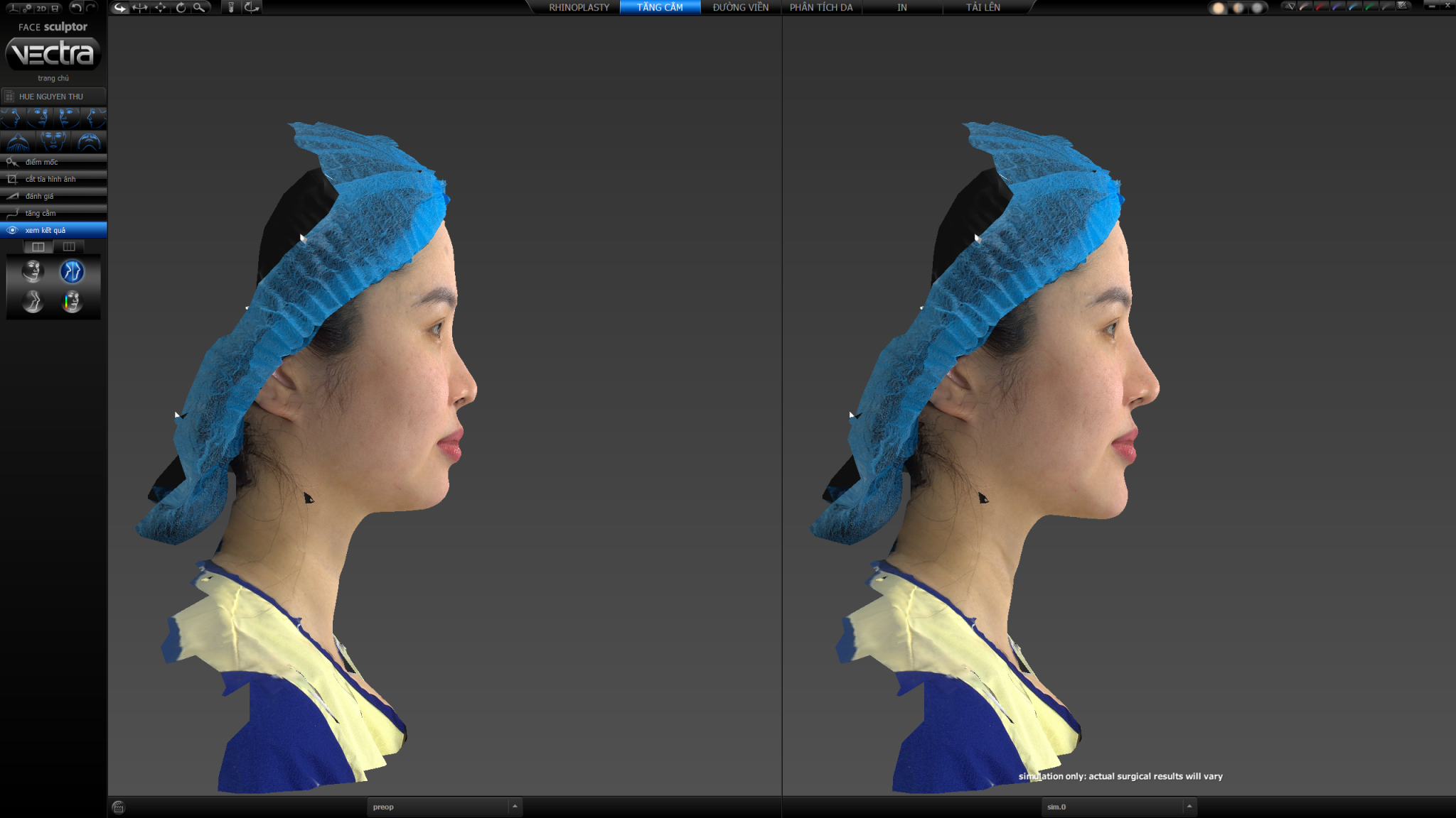 CÔNG NGHỆ MÔ PHỎNG VECTRA XT 3D XEM TRƯỚC DIỆN MẠO TƯƠNG LAI - Thẩm Mỹ ...
