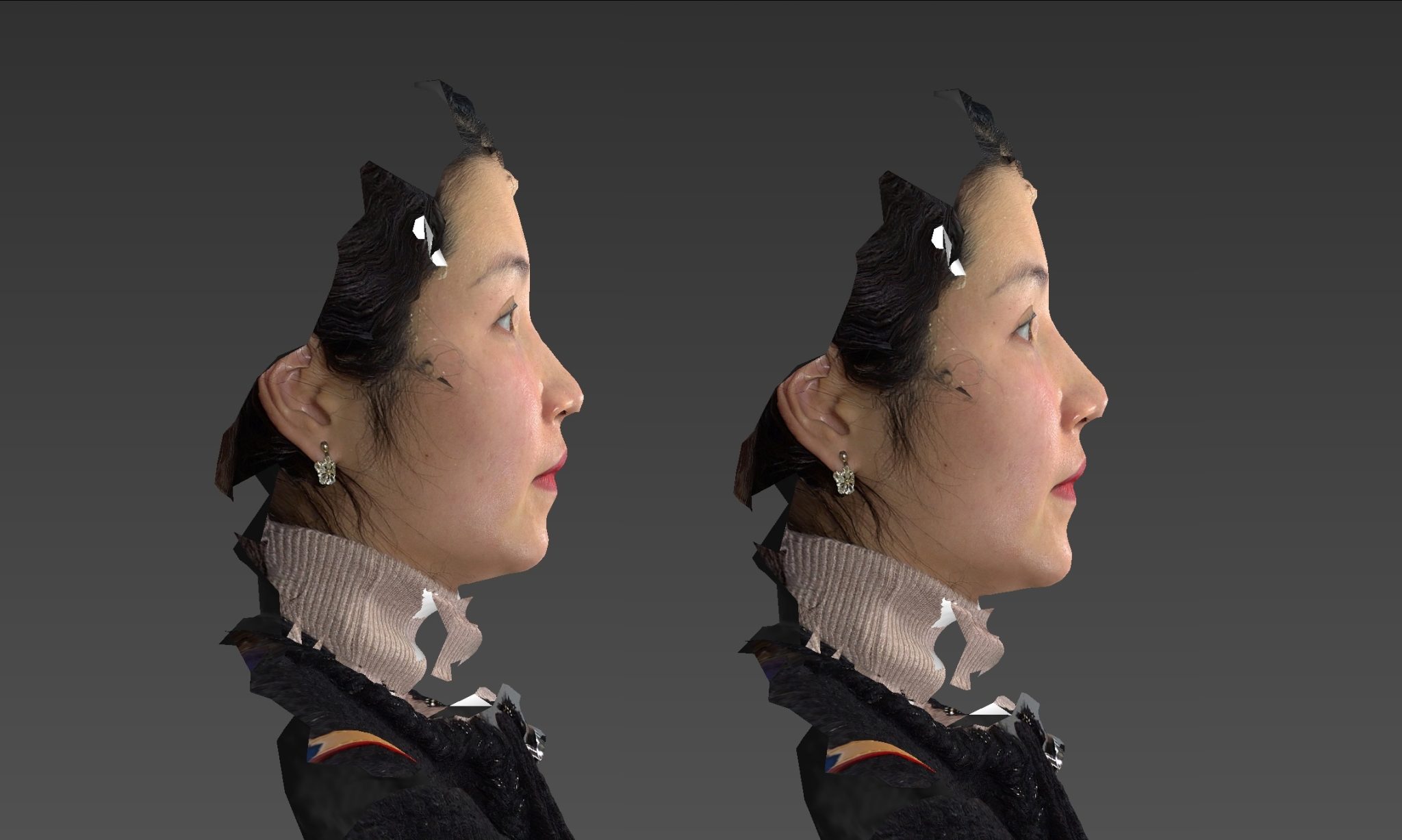 CÔNG NGHỆ MÔ PHỎNG VECTRA XT 3D XEM TRƯỚC DIỆN MẠO TƯƠNG LAI - Thẩm Mỹ ...