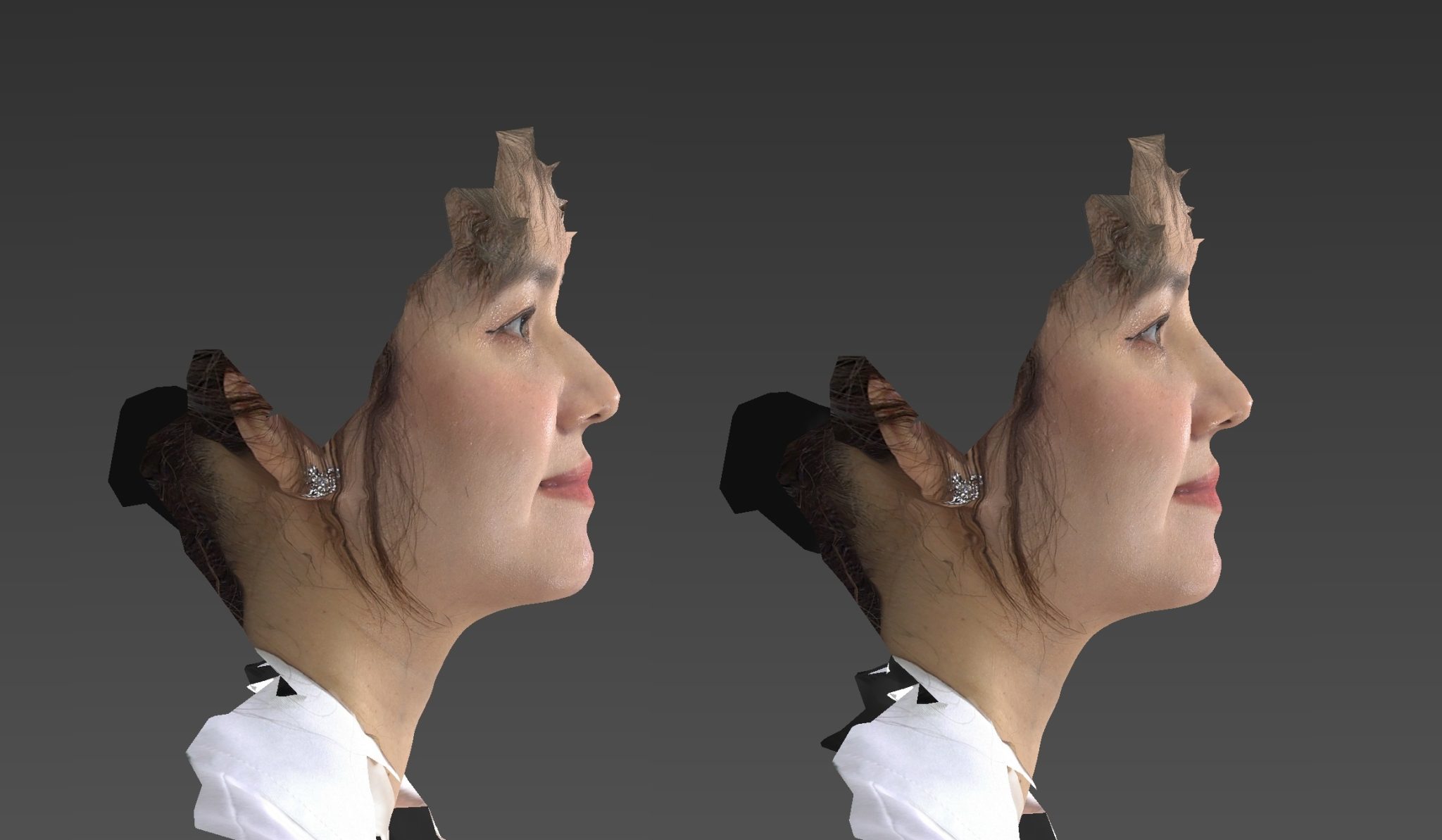 CÔNG NGHỆ MÔ PHỎNG VECTRA XT 3D XEM TRƯỚC DIỆN MẠO TƯƠNG LAI - Thẩm Mỹ ...