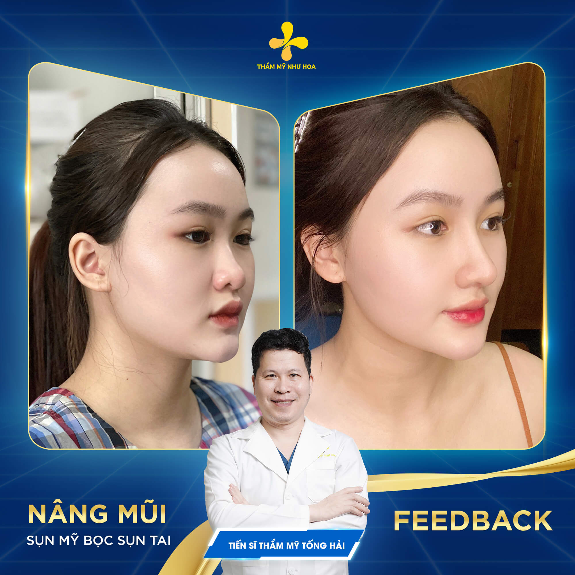 Tiêm tan filler bao lâu thì nâng mũi được